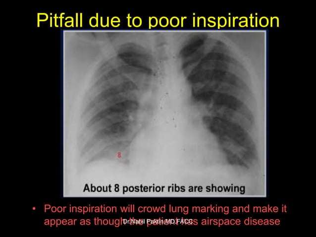 Chest-X ray , How to read a CXR | PPSX | Lung and Respiratory Health ...
