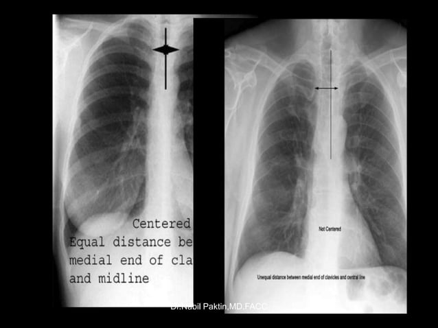 Chest-X ray , How to read a CXR | PPSX | Lung and Respiratory Health ...