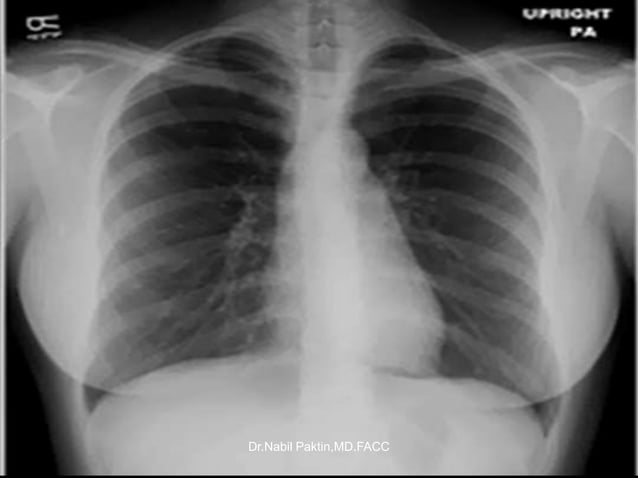 Chest-X ray , How to read a CXR | PPSX | Lung and Respiratory Health | Diseases and Conditions