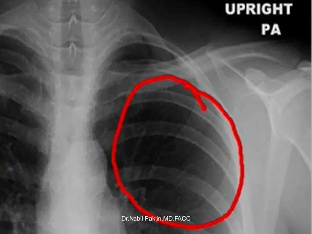 Chest-X ray , How to read a CXR | PPSX | Lung and Respiratory Health | Diseases and Conditions