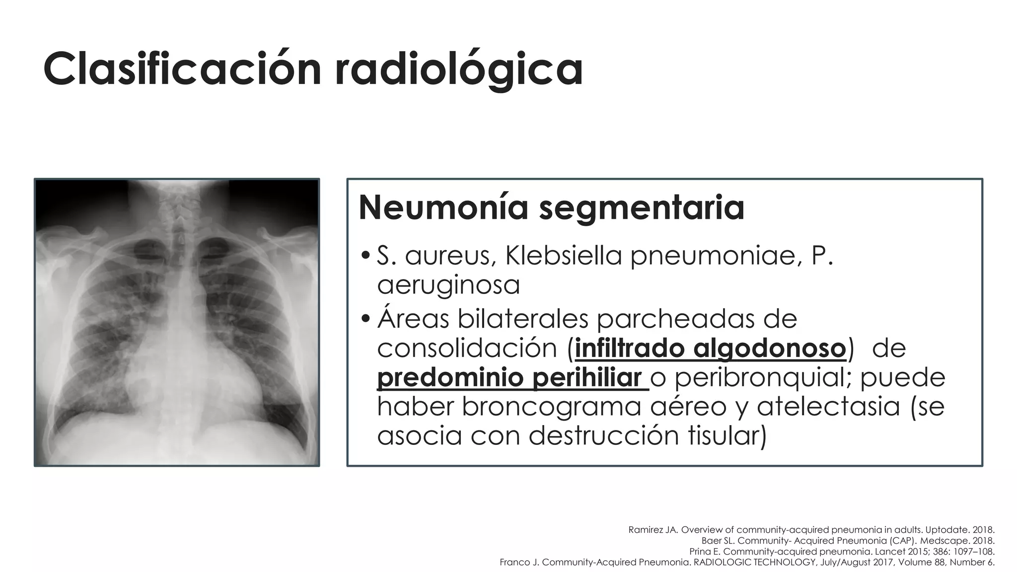 Neumonía adquirida en la comunidad | PDF