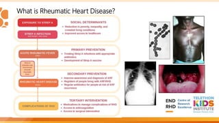 NACCHO 2018 National Conference – END RHD | PPT