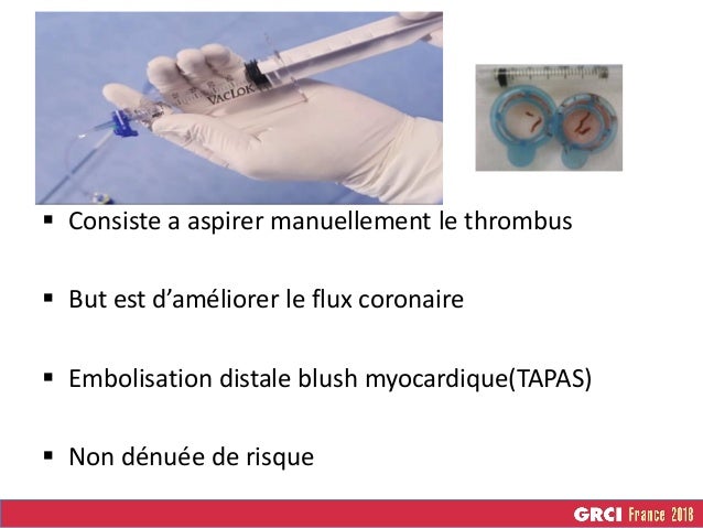 thromboaspiration en 2018