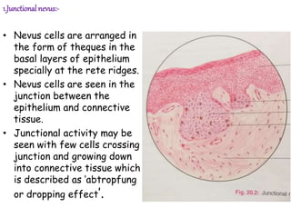 Pigmented Cellular Naevus | PPTX | Skin and Dermatology | Diseases and ...