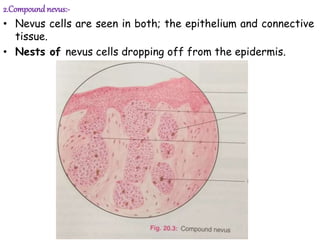 Pigmented Cellular Naevus | PPTX | Skin and Dermatology | Diseases and ...