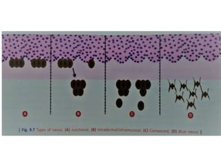 Pigmented Cellular Naevus | PPTX | Skin and Dermatology | Diseases and ...