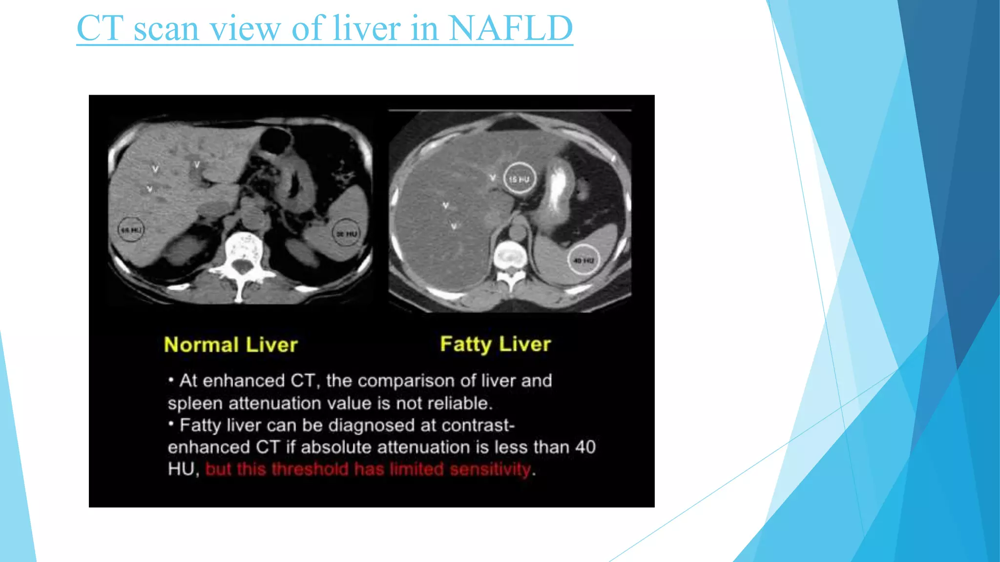 Non Alcoholic Fatty Liver Disease | PPTX