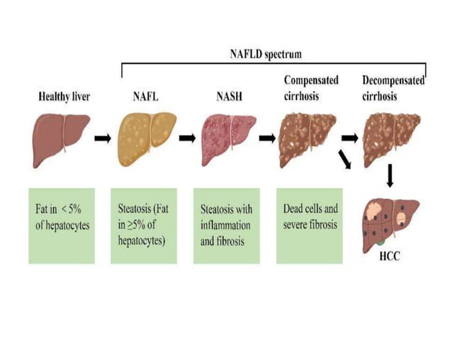 NAFLD non alcoholic fatty liver disease.pptx | Endocrine and Metabolic ...