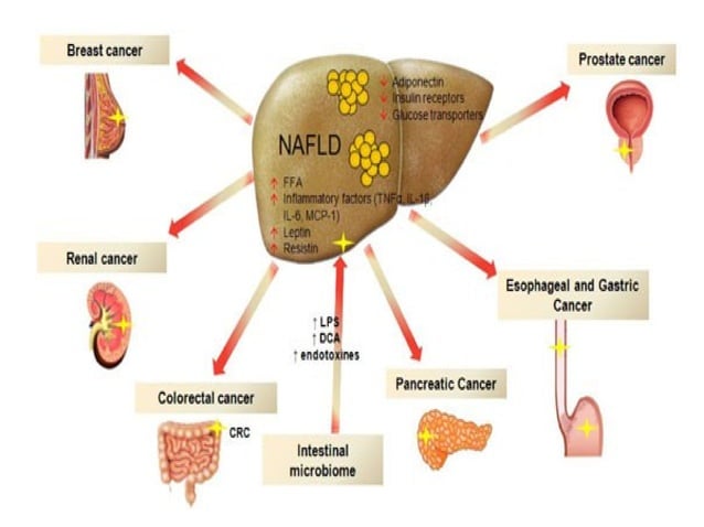 NAFLD A GREAT MASQUERADER A MULTI SYSTEM INVOLVEMENT - | PPT