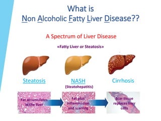 NAFDL: un approccio clinico multidisciplinare | PPT