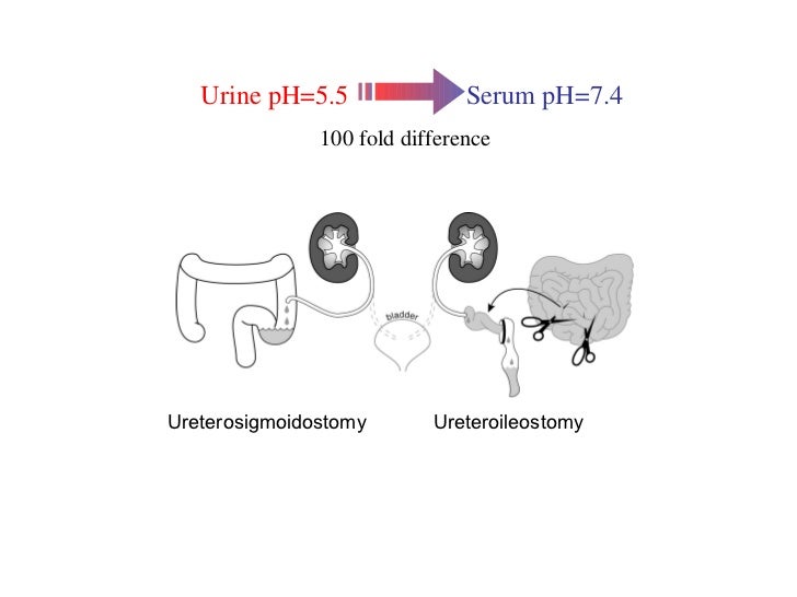 Non-anion gap Metabolic Acidosis (NAGMA)