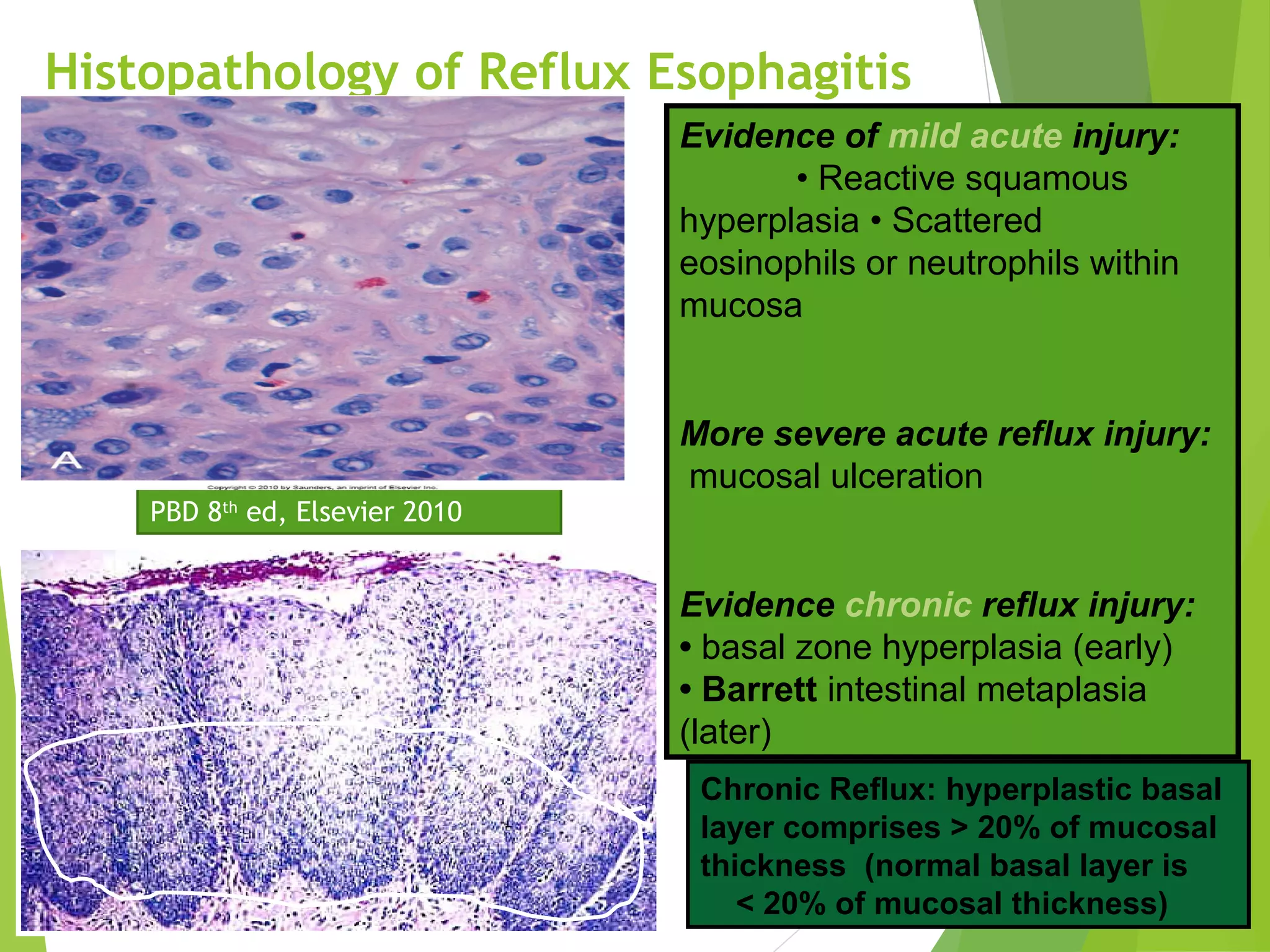Pathology of the Esophagus | PPT
