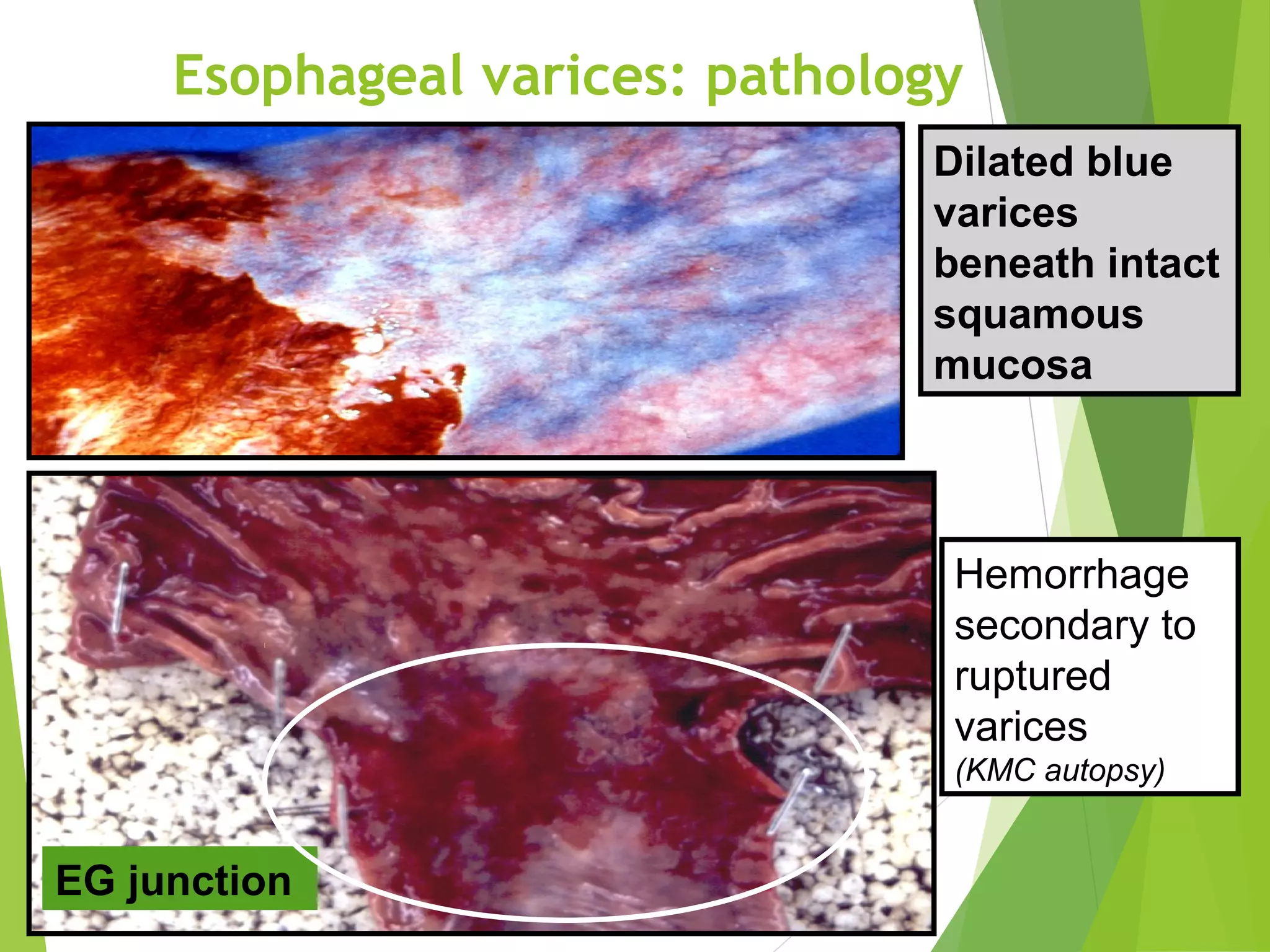 Pathology of the Esophagus | PPT