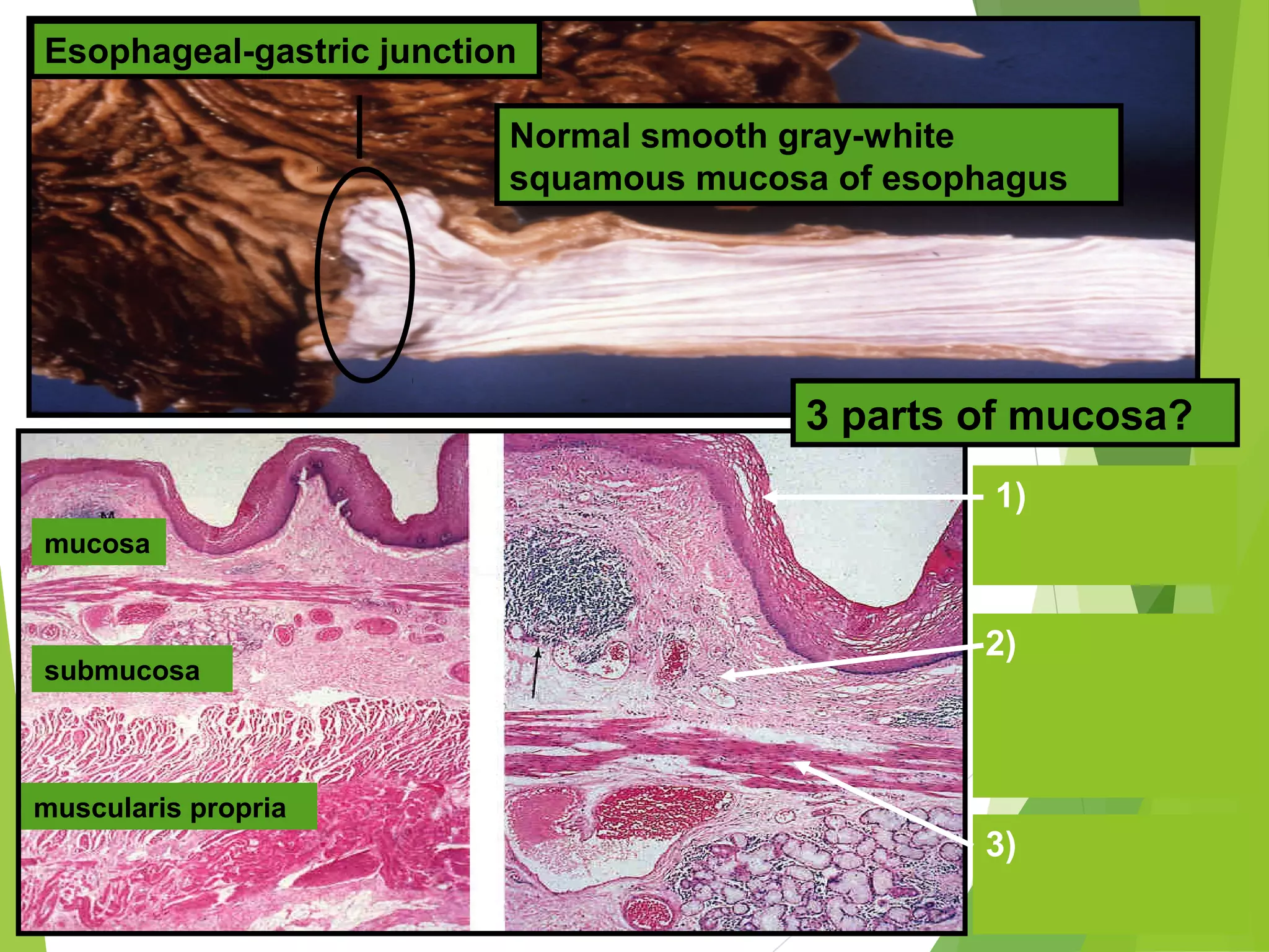 Pathology of the Esophagus | PPT