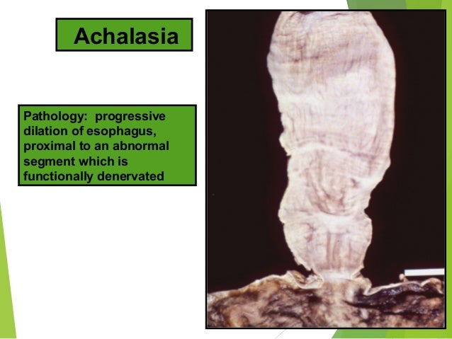 Pathology of the Esophagus
