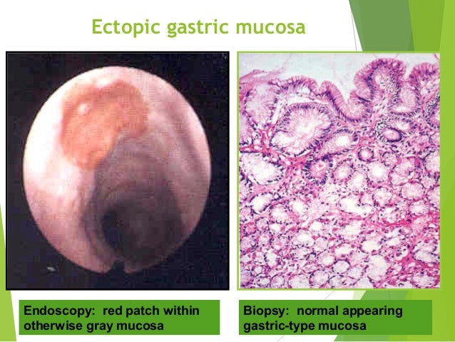 Pathology of the Esophagus