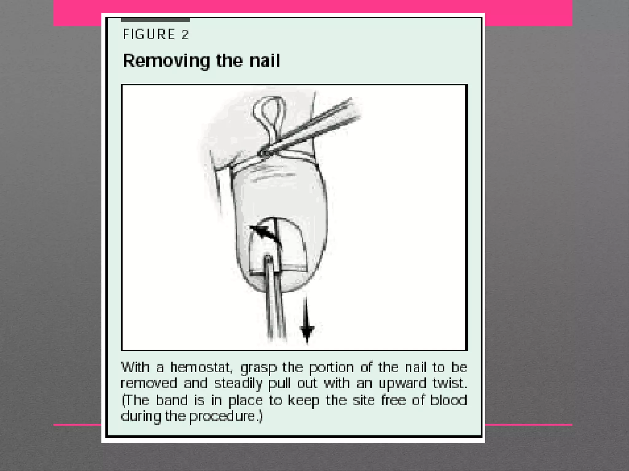 NAIL AVULSION | PPT