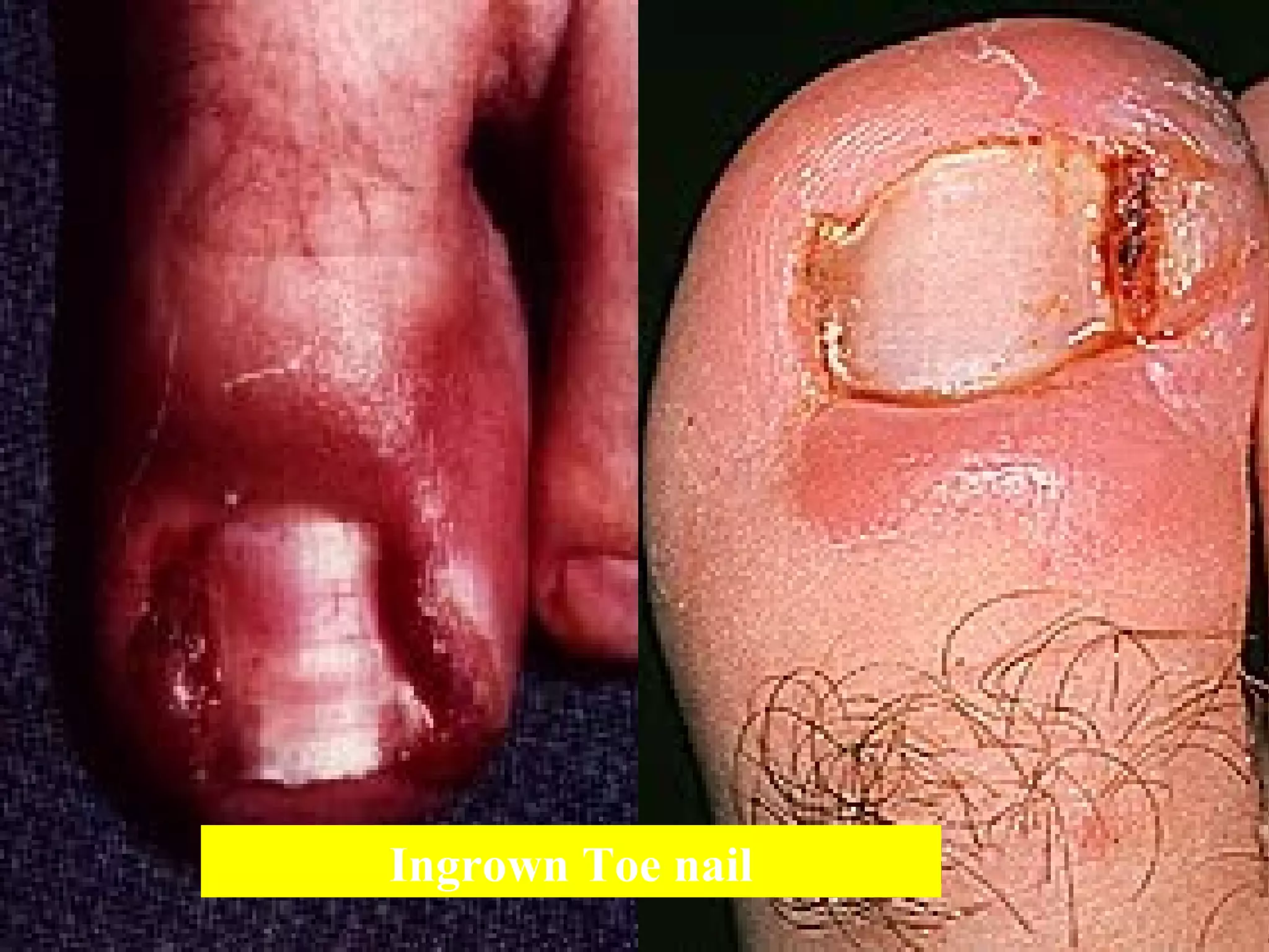 NAIL AVULSION | PPT