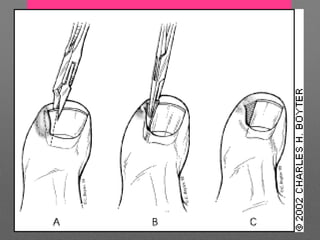 NAIL AVULSION | PPT