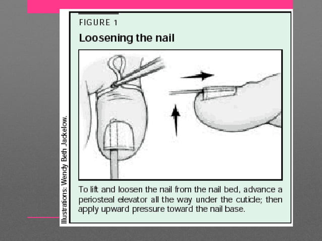 NAIL AVULSION