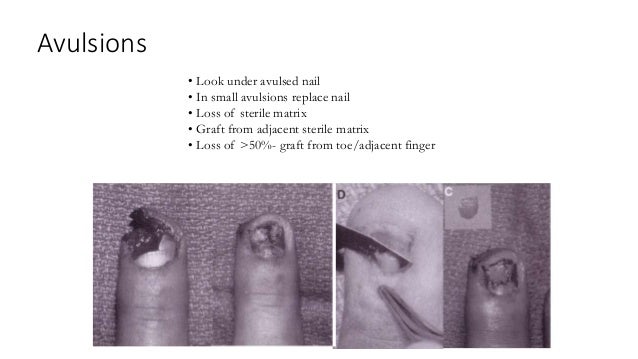 Nail bed injuries