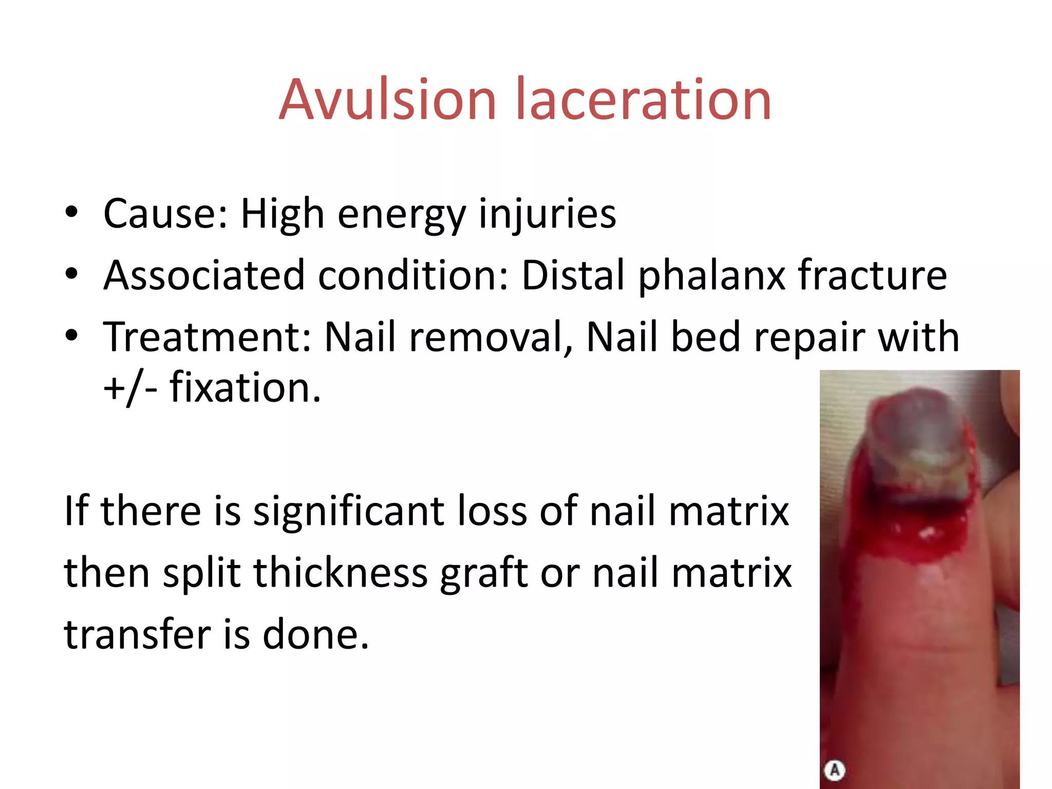 Nail bed injury | PPTX