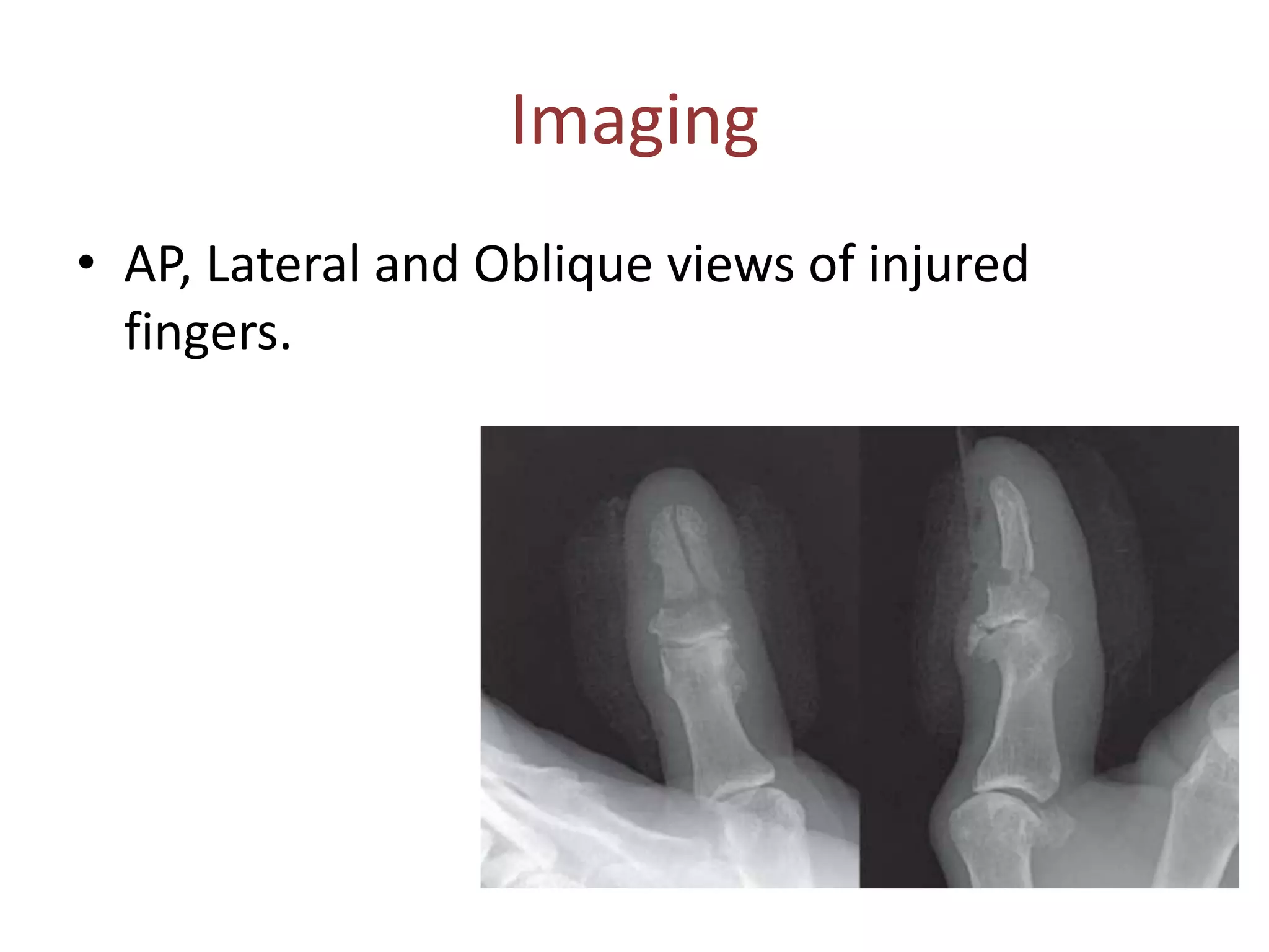 Nail bed injury | PPTX
