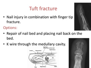Nail bed injury | PPTX | Death, Injury, or Military Conflict ...