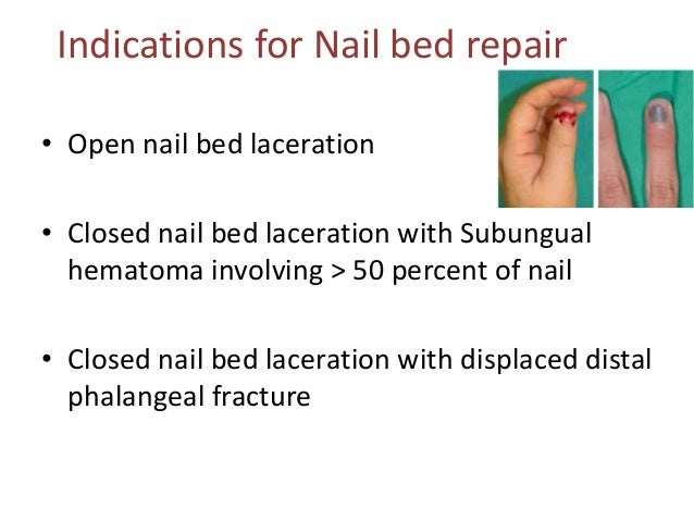 Nail bed injury