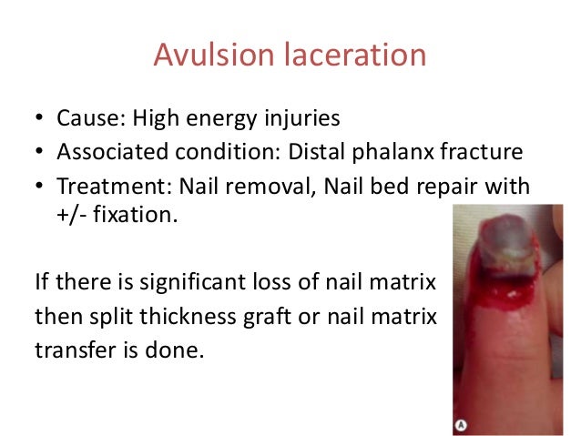 Nail bed injury