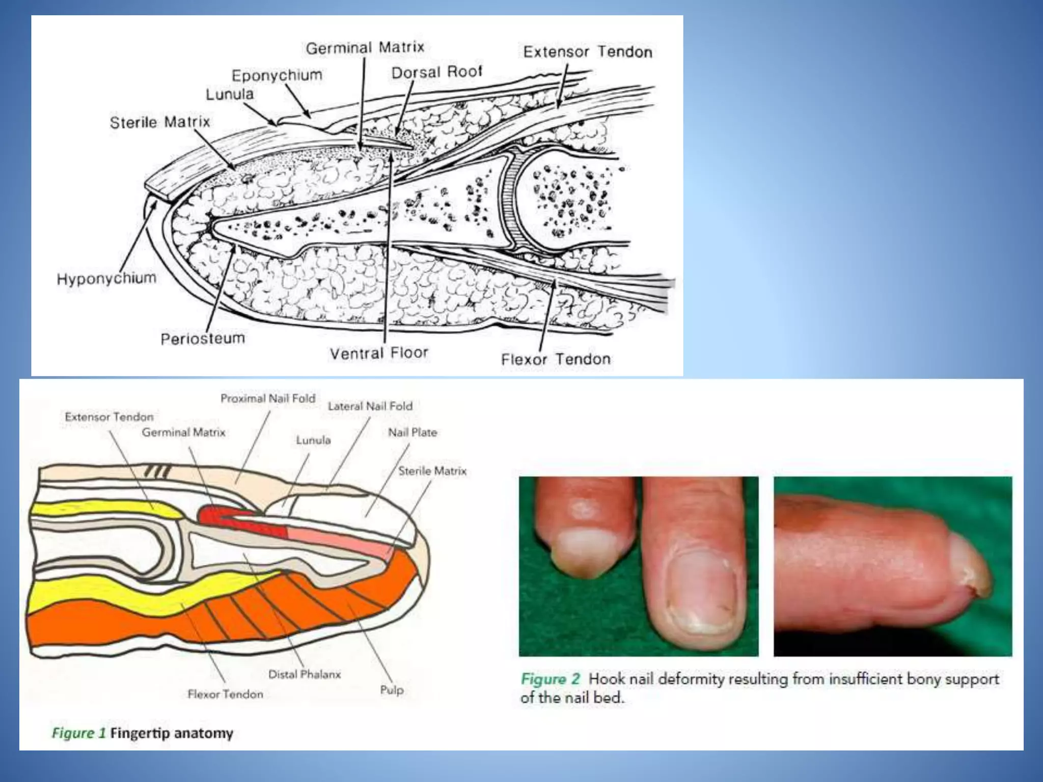 Nail bed injury_XRC.pptx