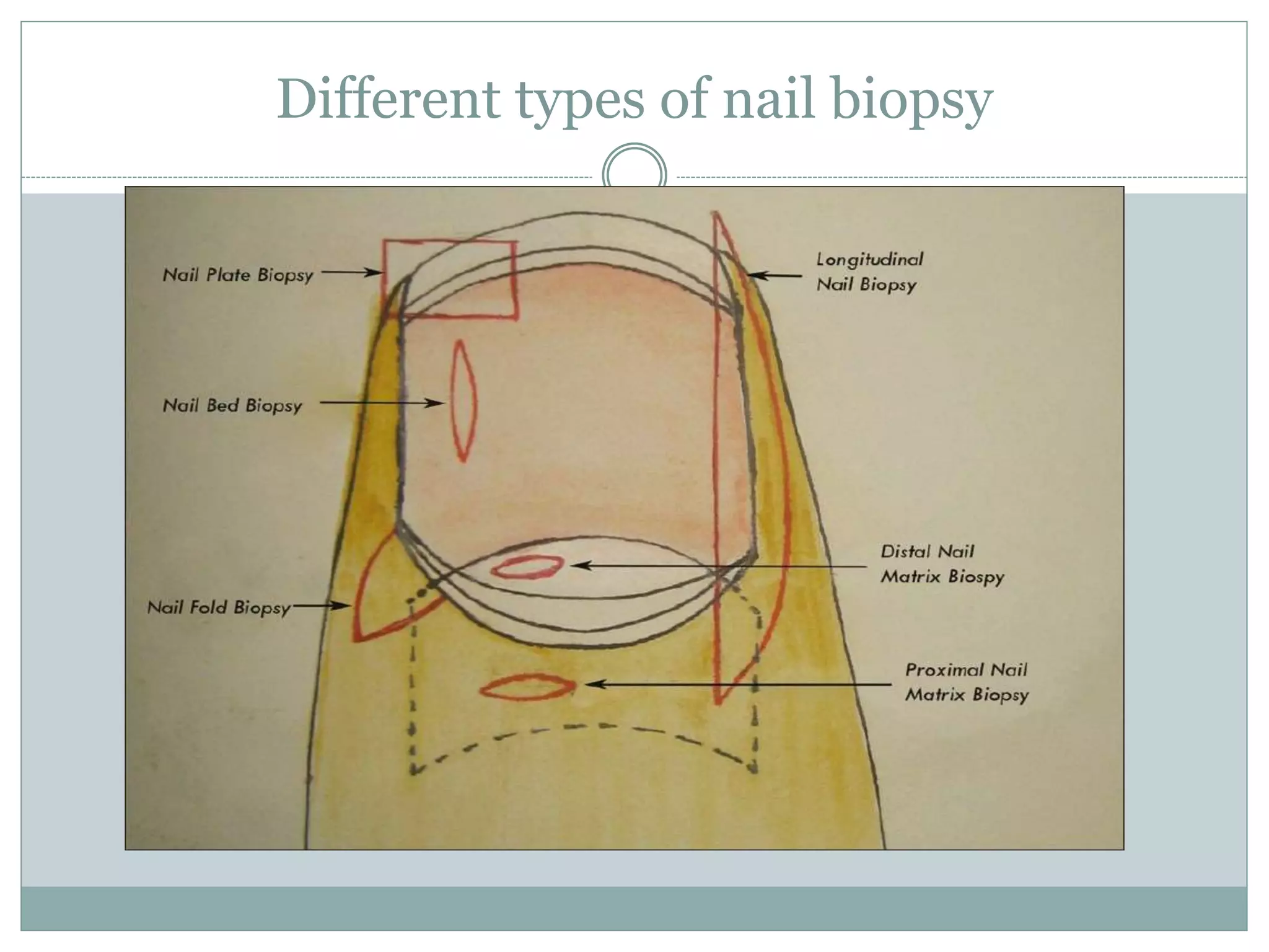 Nail biopsy | PPTX