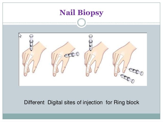 Nail biopsy