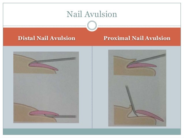 Nail biopsy