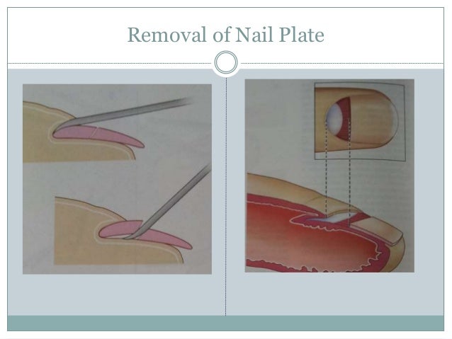Nail biopsy
