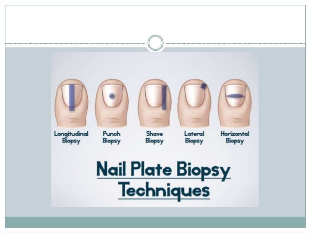 Nail biopsy