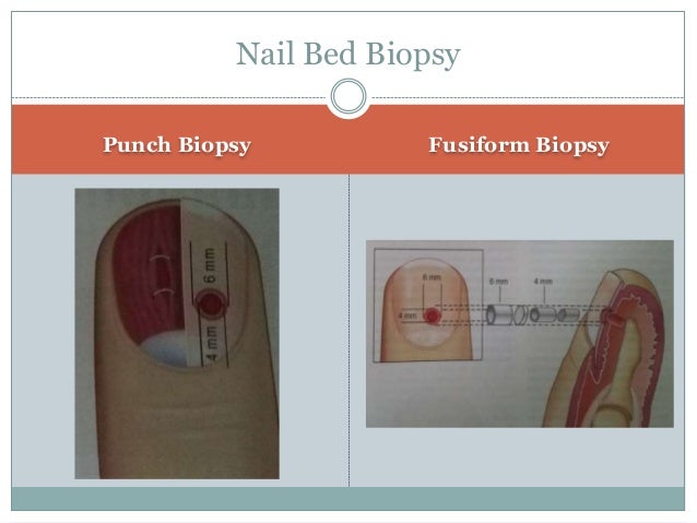 Nail biopsy