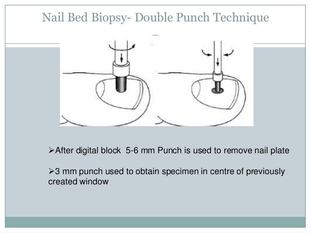 Nail biopsy
