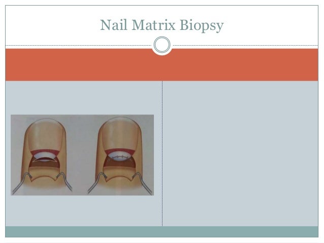 Nail biopsy