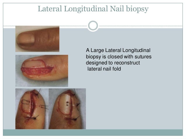 Nail biopsy