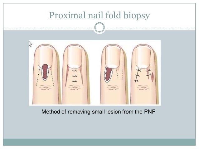 Nail biopsy