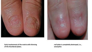 Nail changes on different dermatologic disease | PPTX