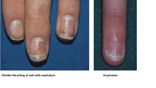 Nail changes on different dermatologic disease