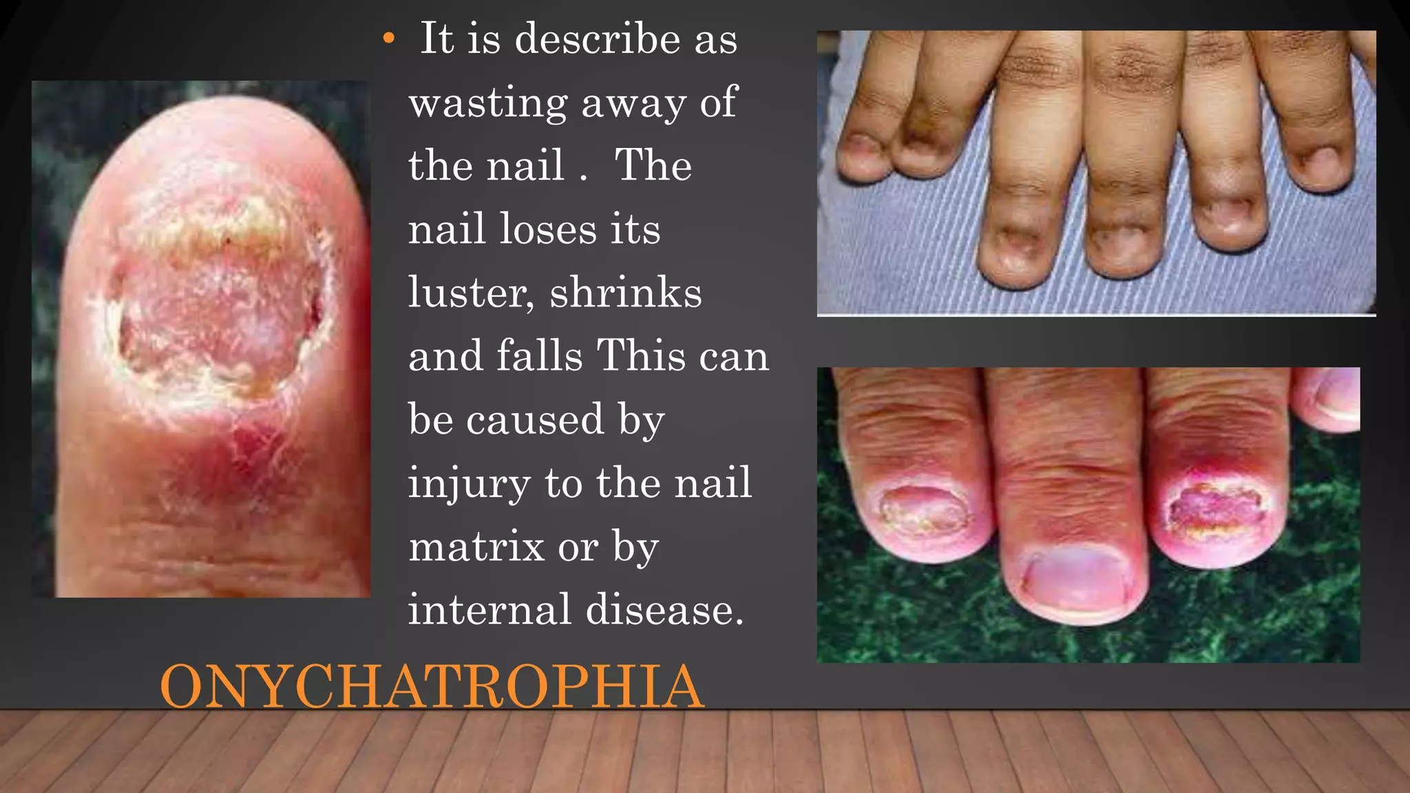 Nail diseases and disorders | PPTX