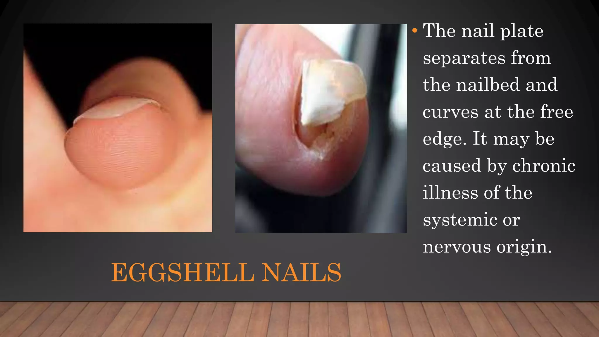 Nail diseases and disorders | PPTX