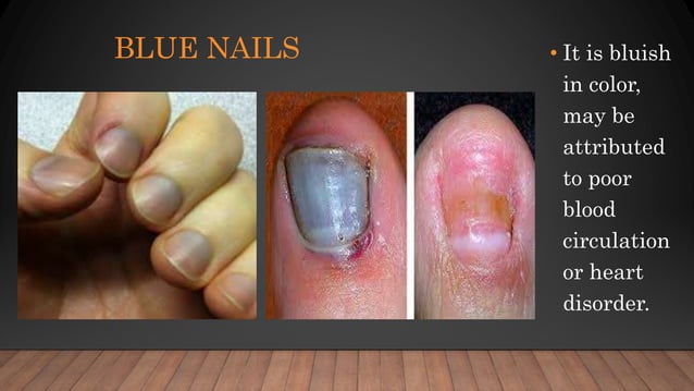 Nail diseases and disorders