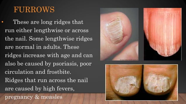 Nail diseases and disorders