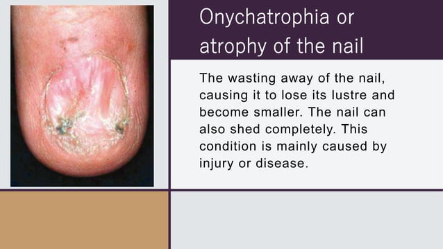 Nail Diseases and Disorders.pptx