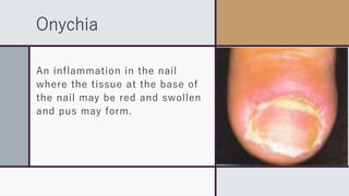 Nail Diseases and Disorders.pptx