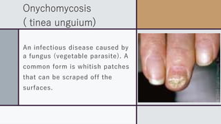 Nail Diseases and Disorders.pptx